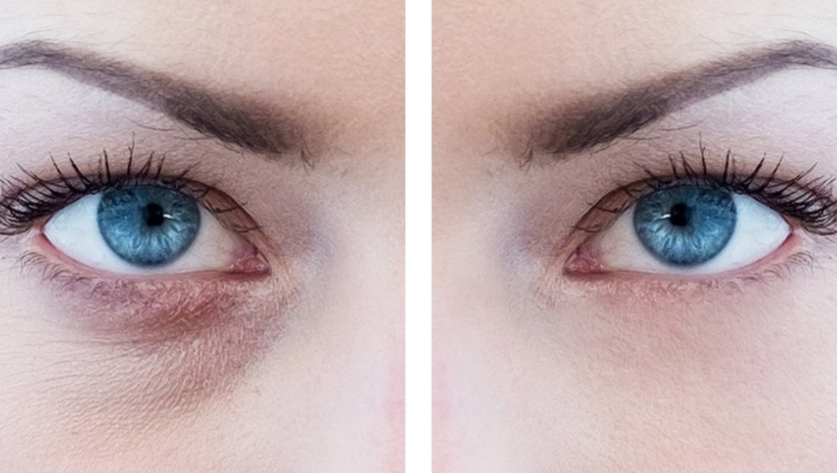 How To Reduce Or Remove Eye Bags In Photoshop Fstoppers