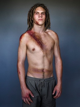 Car Crash Survivors Pose With Seatbelt Wounds for New Photography ...